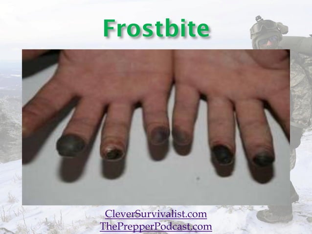 Cold Weather Injuries, Hypothermia, Frostbite, Frostnip, Trenchfoot ...