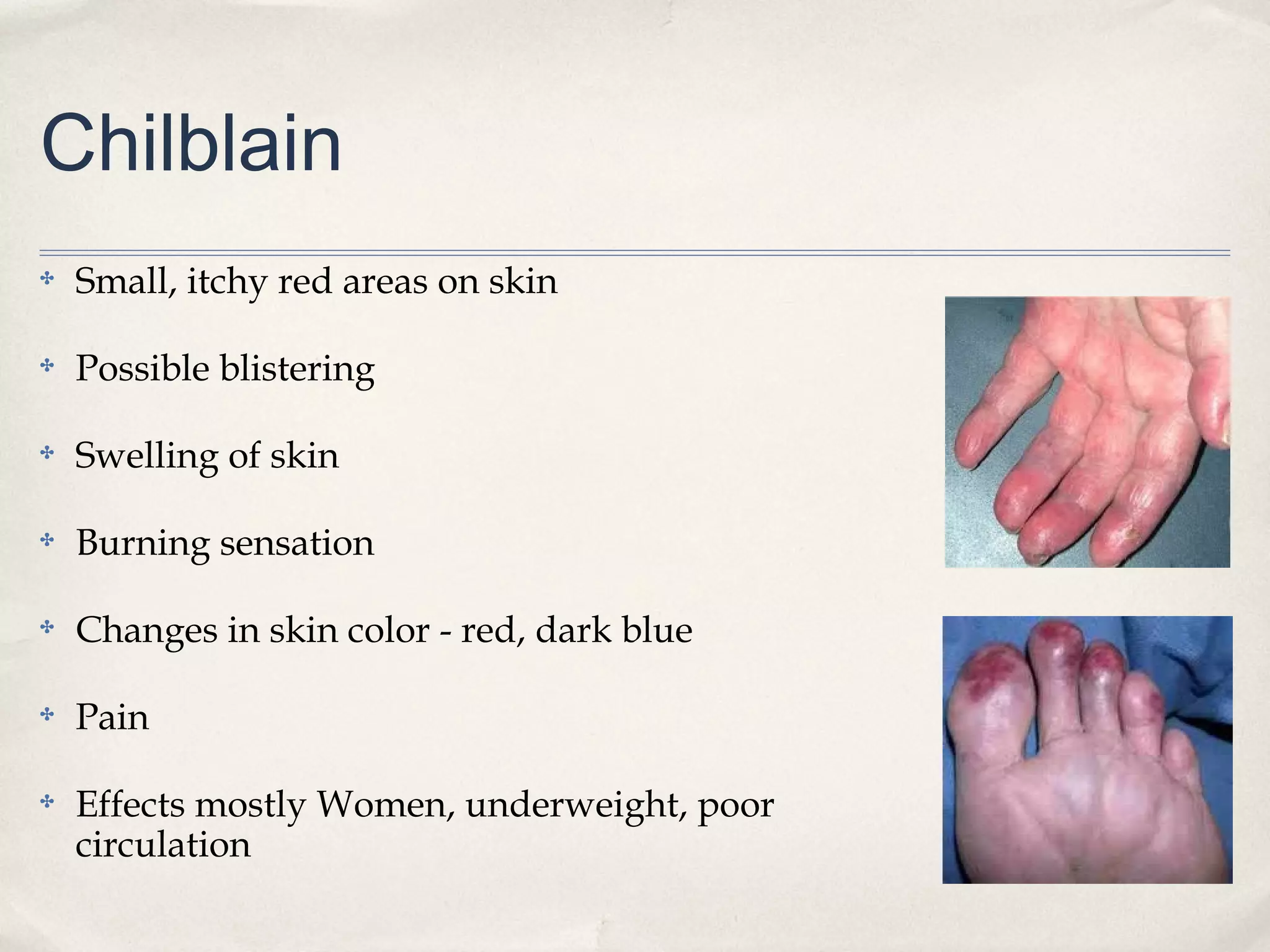 Cold Weather Injuries (Military) | PPT