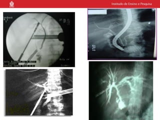 Colangiografia | PDF