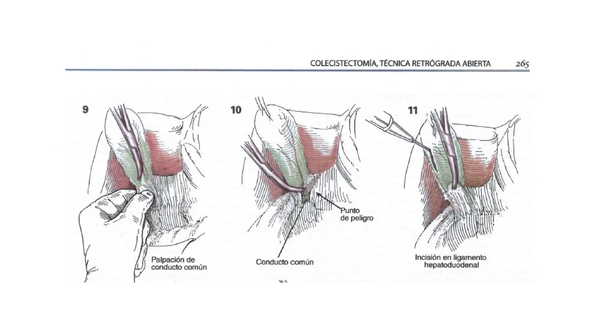 Colecistectomía - Técnica quirúrgica abierta.pptx