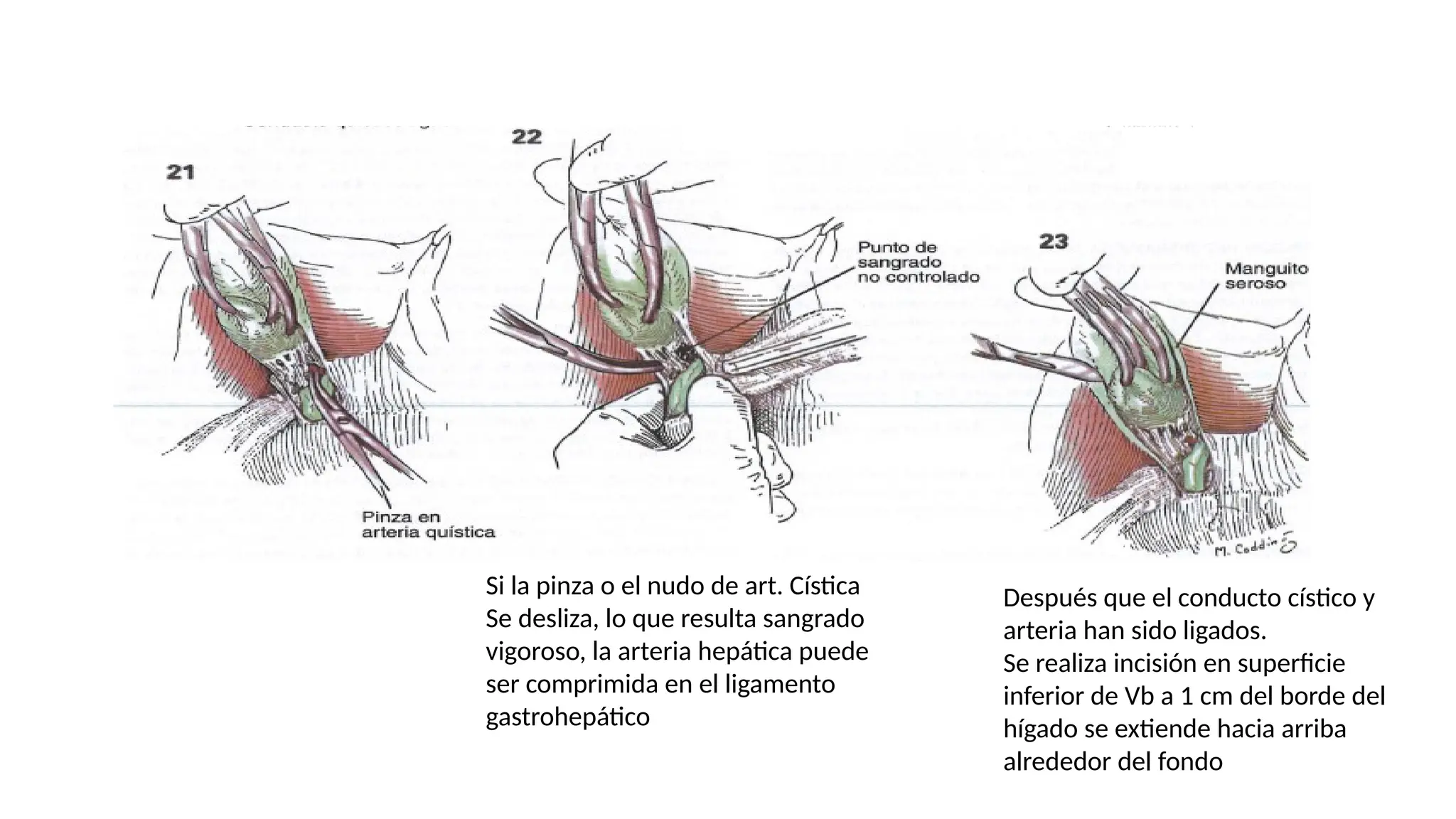 Colecistectomía - Técnica quirúrgica abierta.pptx