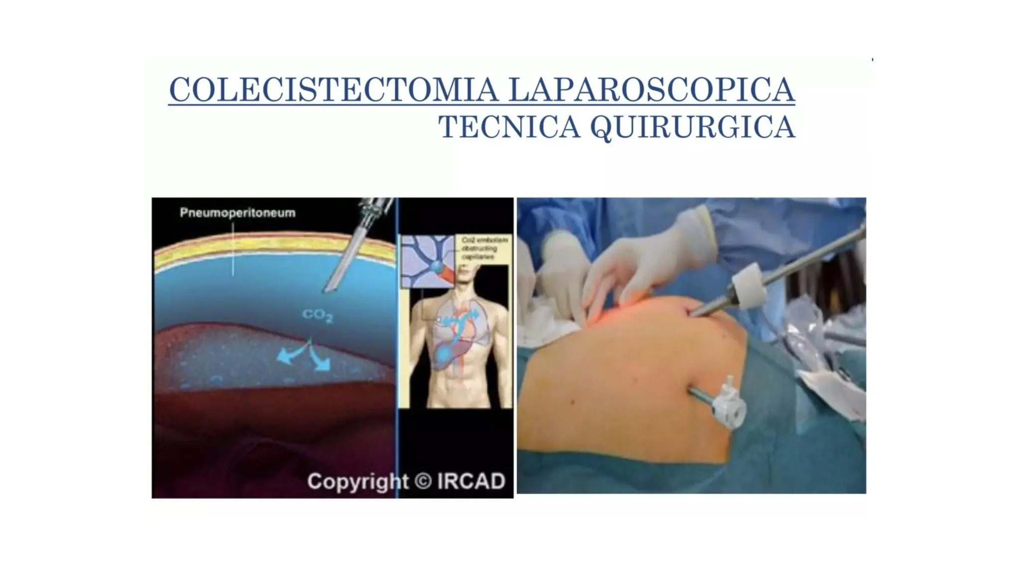 Colecistectomía Técnica Quirúrgica Abierta Pptx