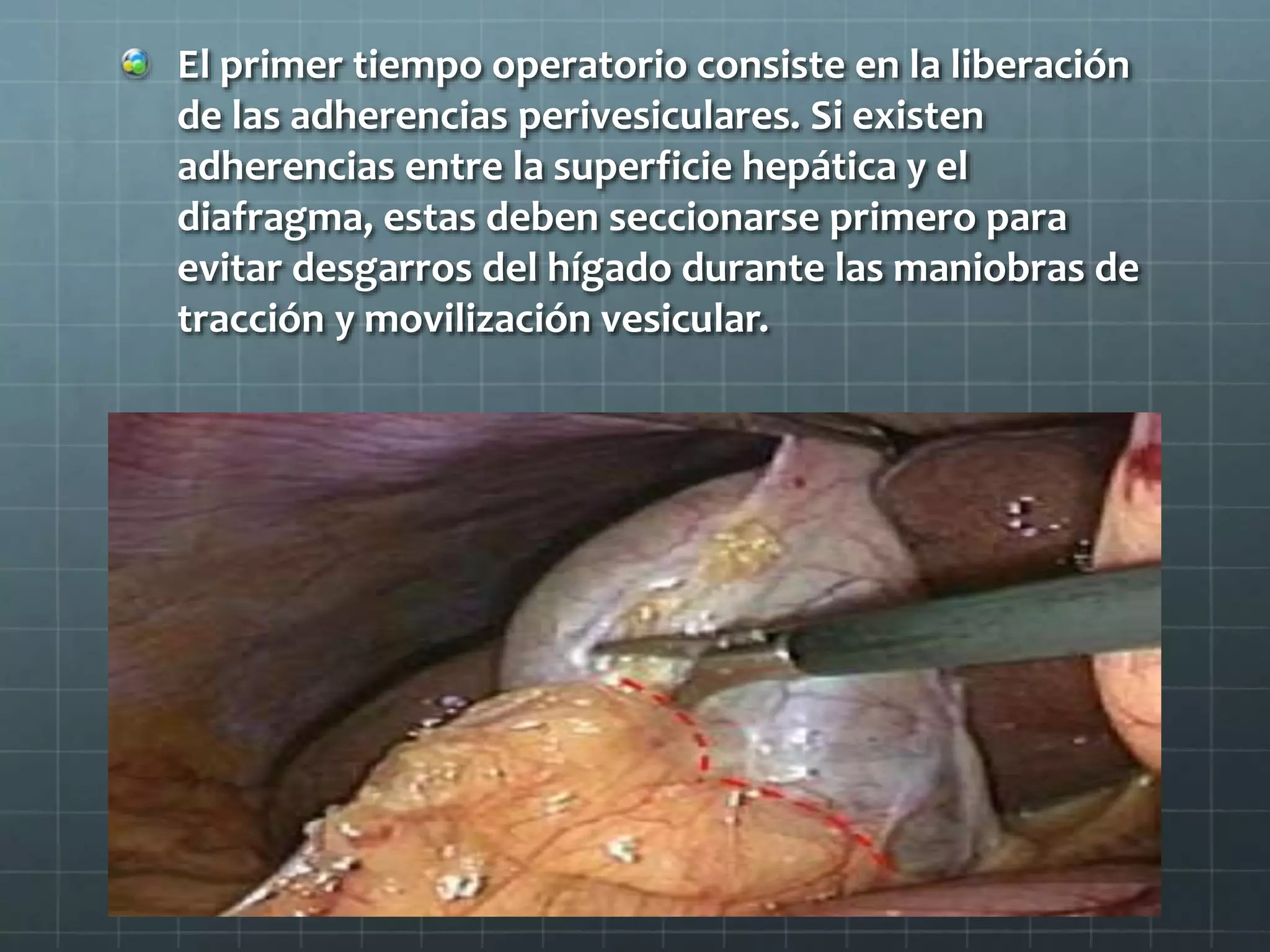 Colecistectomia laparoscopica | PPTX