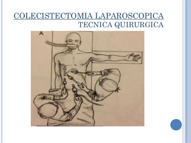 Colecistectomia laparoscopica