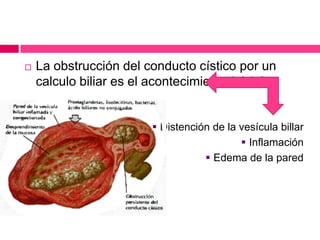 Colecistitis | PPTX