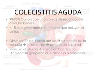 Colecistitis | PPTX