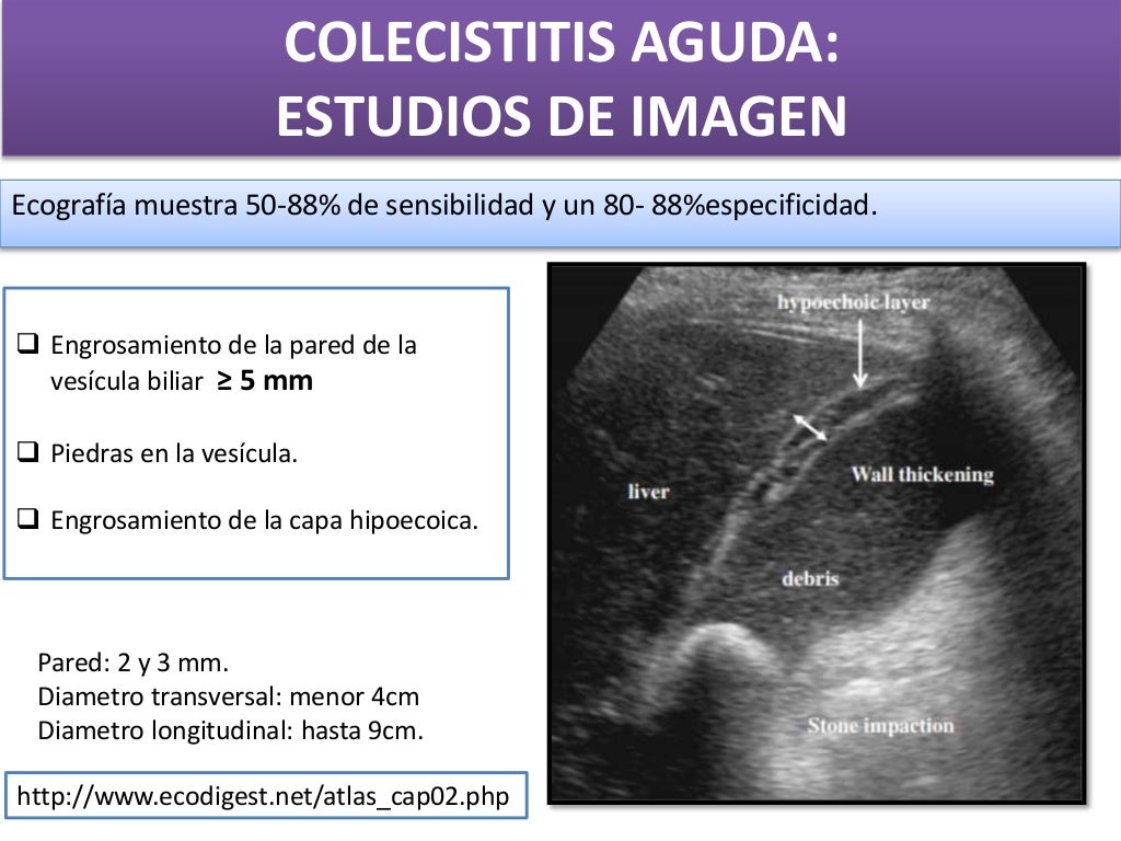 Colecistitis Aguda