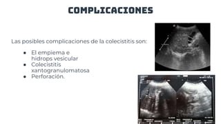 Colecistitis.pptx