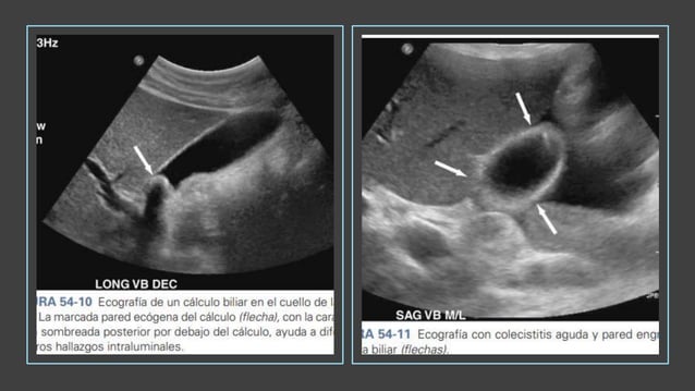 Colecistitis Cronica litiasica Fisiopatologia, Diagnostico y ...