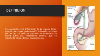 Colecistitis Cronica litiasica Fisiopatologia, Diagnostico y ...