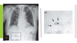 Comprehensive Overview of Acute Cholecystitis: Diagnosis, Severity, and ...