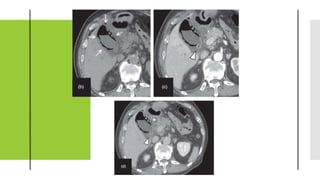 Comprehensive Overview of Acute Cholecystitis: Diagnosis, Severity, and ...