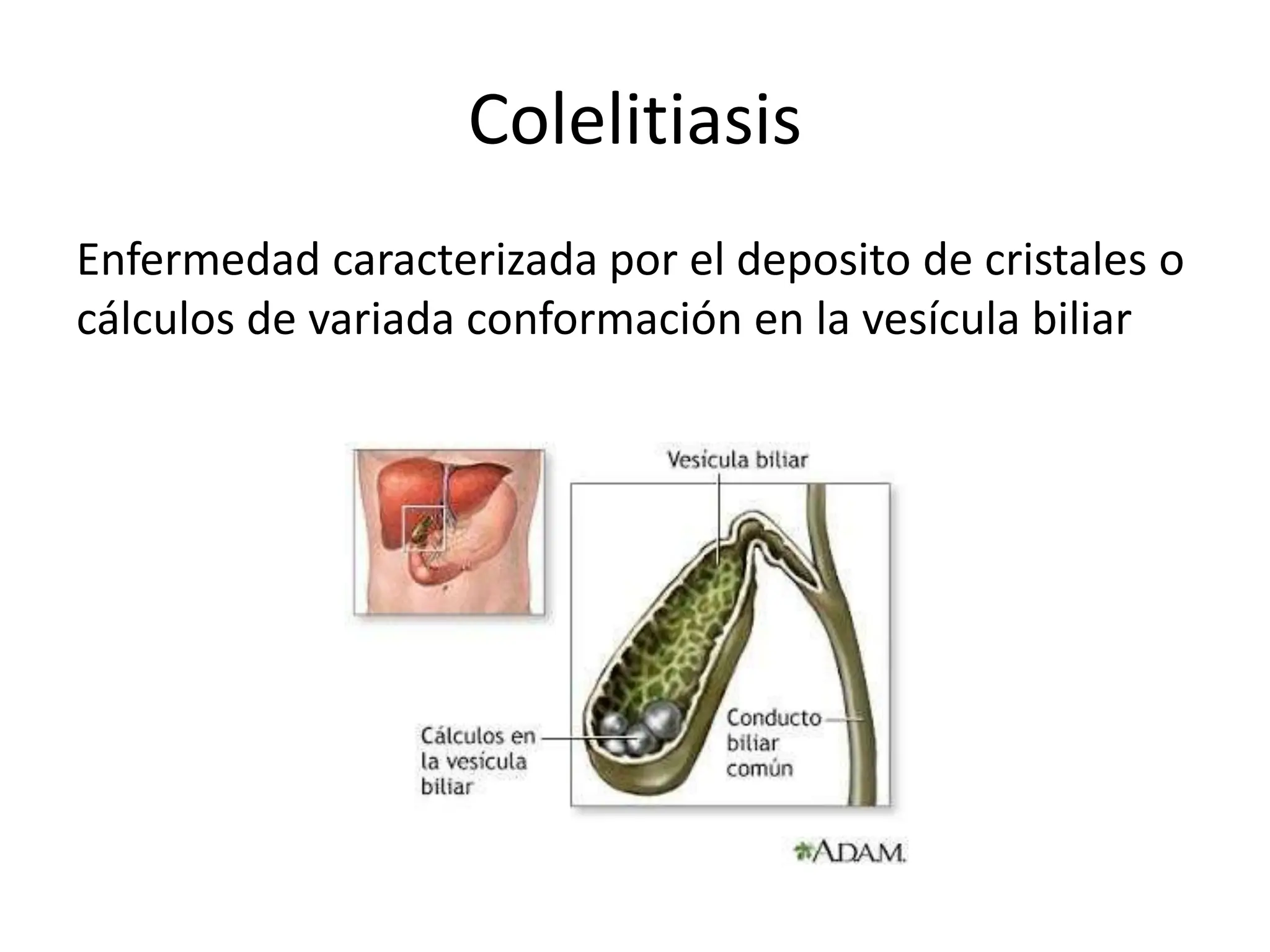 COLECISTITIS AGUDA ABDOMEN AGUDO PATOLOGIA BILIAR | PPTX