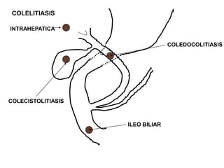Colecistitis y Colecistolitiasis | PPT