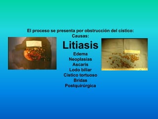 Colecistitis y Colecistolitiasis | PPT