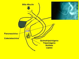 Colecistitis y Colecistolitiasis | PPT
