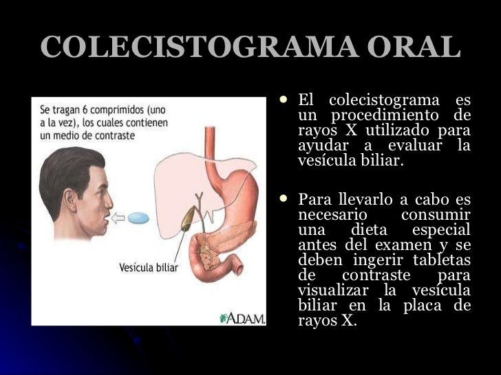 Colecistitis Colelitiasis Y Coledocolitiasis 1 Images Colecistitis Colelitiasis Y Coledocolitiasis 1 Images