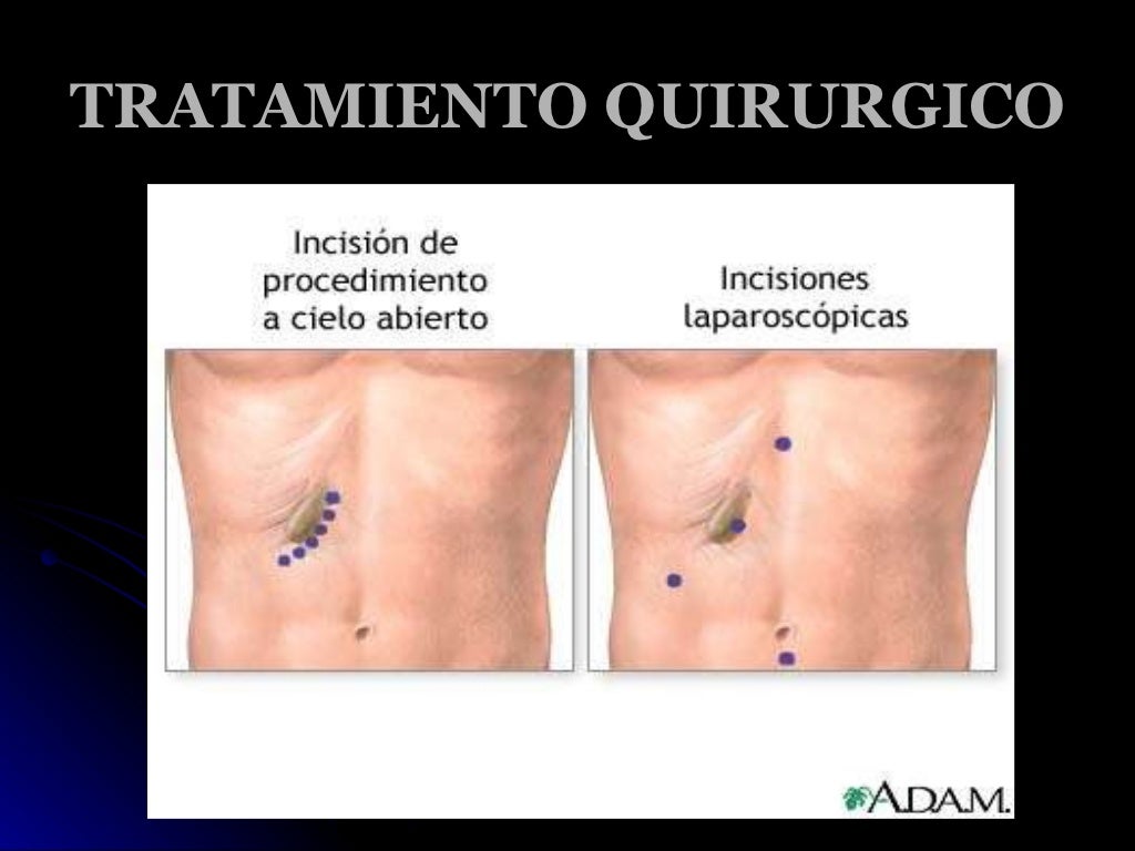 Colecistitis Colelitiasis Y Coledocolitiasis 1 Images Colecistitis Colelitiasis Y Coledocolitiasis 1 Images