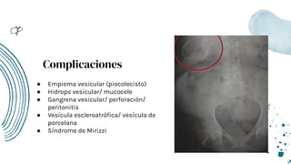 Colecistitis litiásica aguda exposicion | PDF