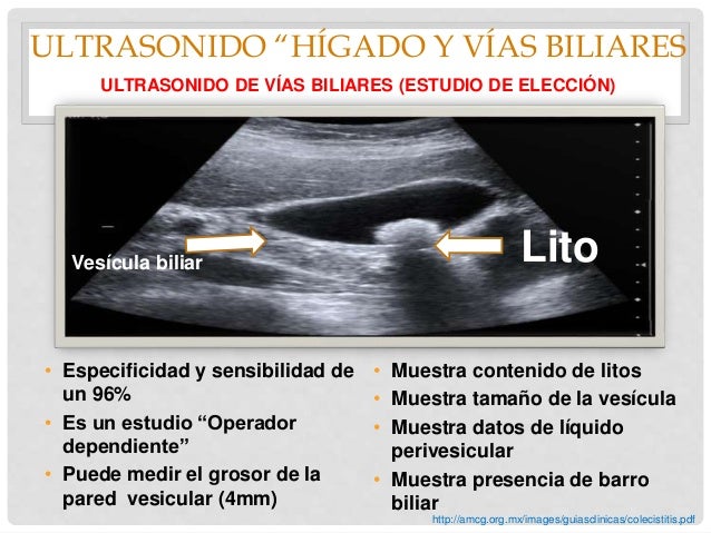 Colecistitis aguda y colelitiasis