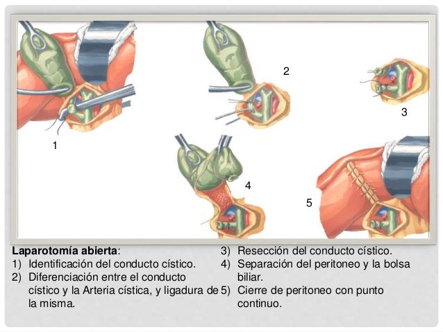 Colecistitis aguda y colelitiasis