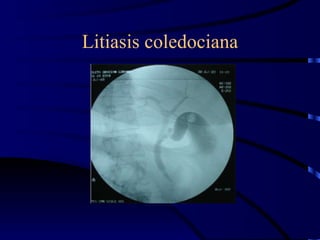 Colecistitis y coledocolitiasis | PPT