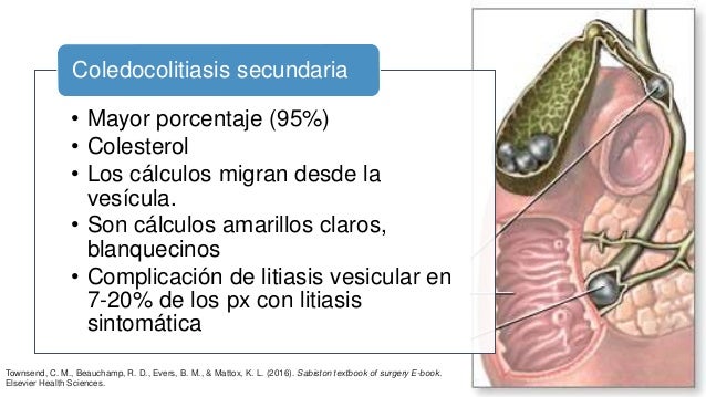 Coledocolitiasis