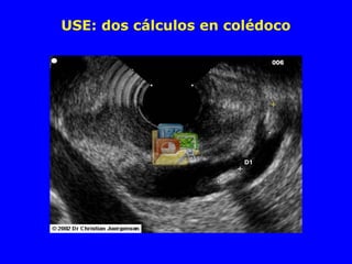 Coledocolitiasis, Colangitis | PPT
