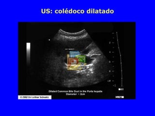 Coledocolitiasis, Colangitis | PPT