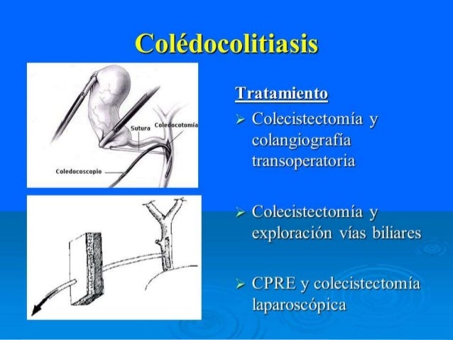 Coledocolitiasis