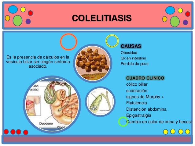 Colelitiasis y colecistitis