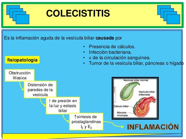 Colelitiasis y colecistitis