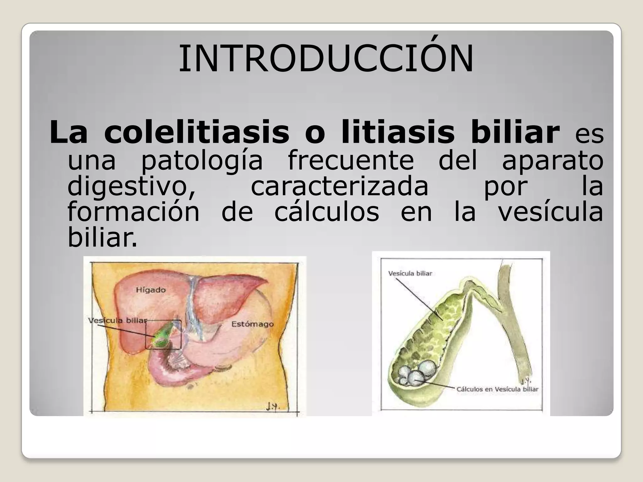 Colelitiasis