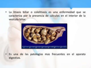 Colelitiasis | PPTX