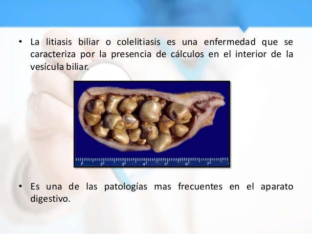 Colelitiasis