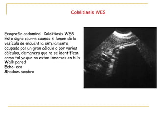 Colelitiasis | PPT