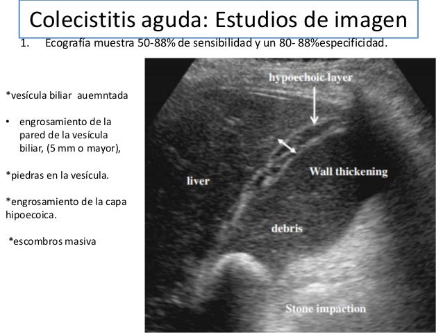 COLELITIASIS , COLECISTITIS, GUIAS TOKYO