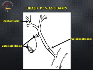 COLELITIASIS Y SUS COMPLICACIONES....... | PPT