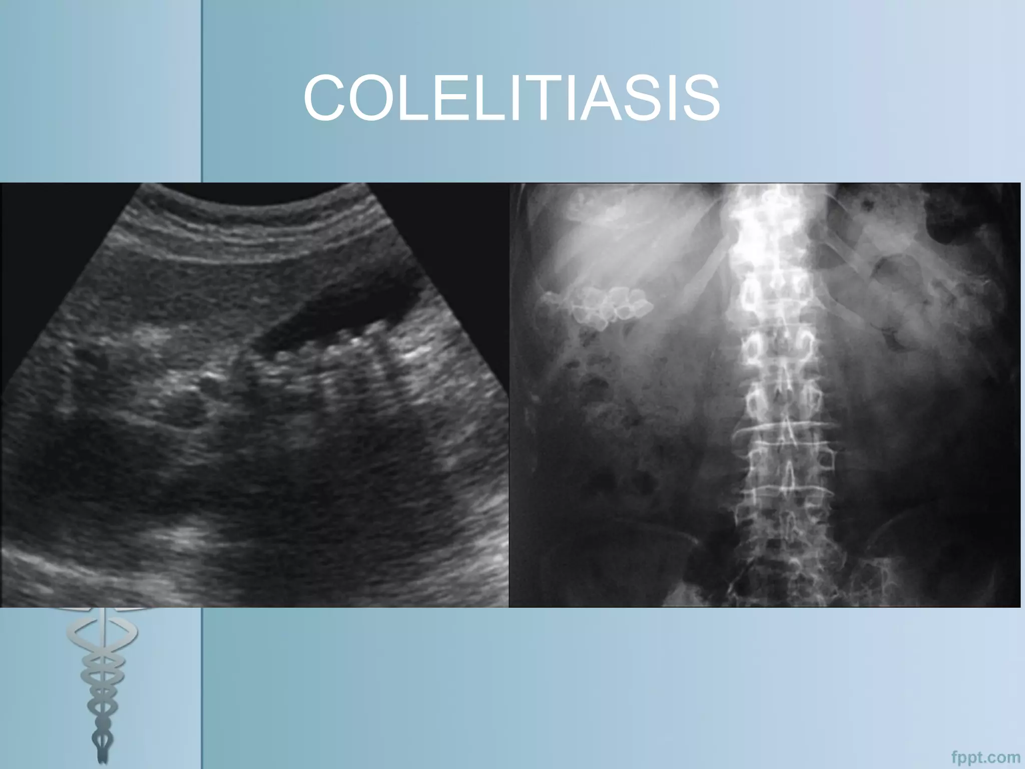 Colelitiasis (3)