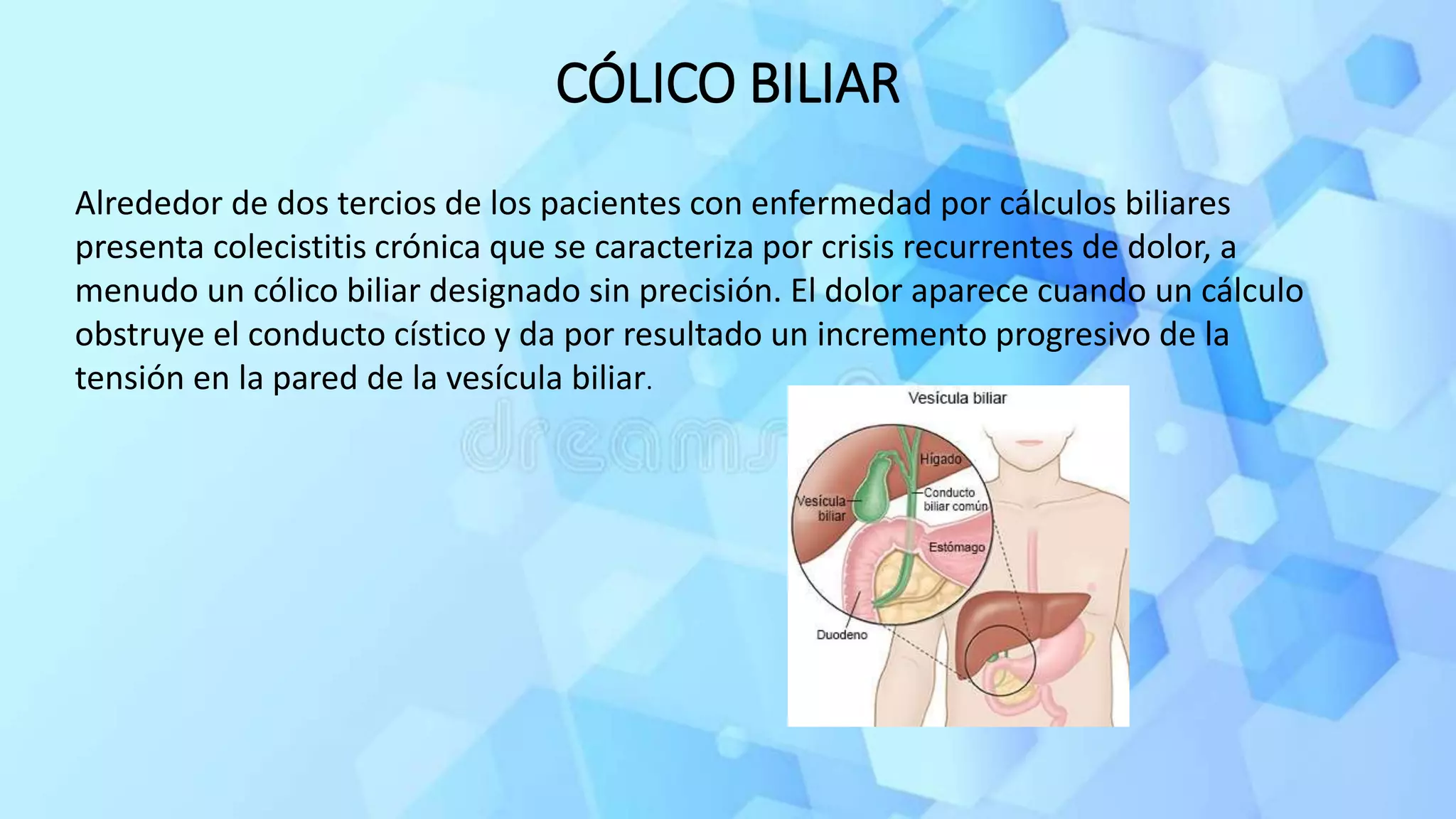 colelitiasis,colico biliar y colecistitis aguda letícia leit.pptx