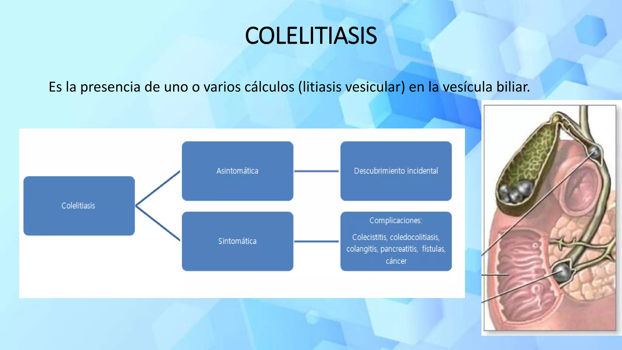colelitiasis,colico biliar y colecistitis aguda letícia leit.pptx