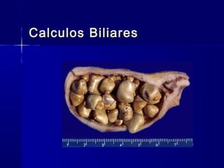 Colelitiasis dr bayohan | PPT