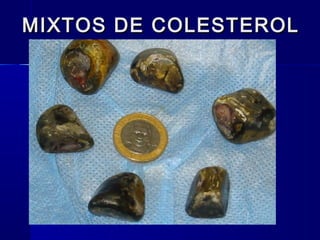 Colelitiasis dr bayohan | PPT