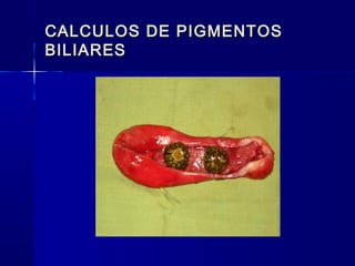 Colelitiasis dr bayohan | PPT