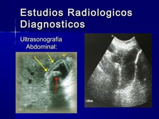 Colelitiasis dr bayohan | PPT