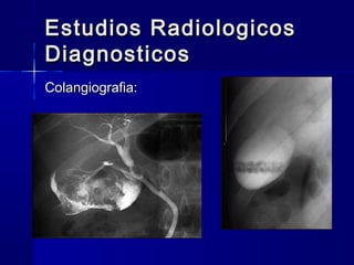 Colelitiasis dr bayohan | PPT