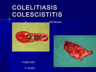 Colelitiasis dr bayohan | PPT