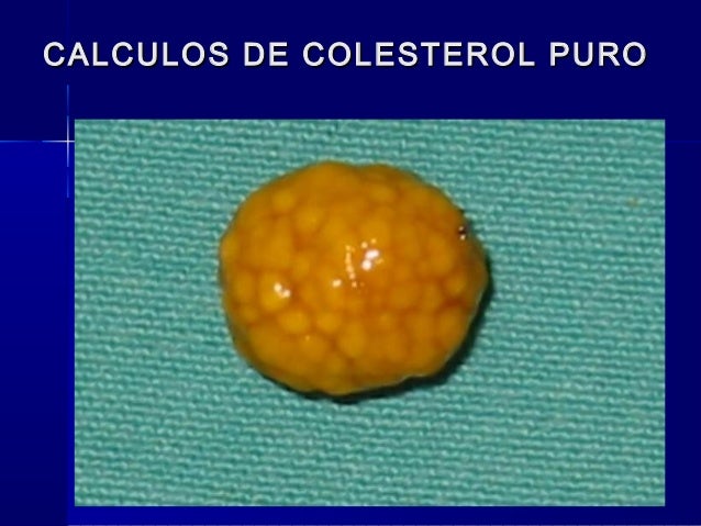 Colelitiasis dr bayohan