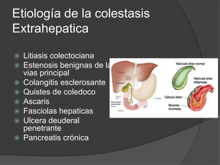Colesistitis.pptx