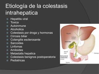 Colesistitis.pptx